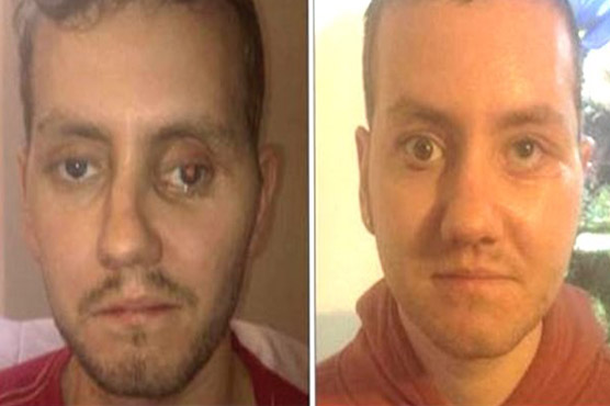 British man's face rebuilt using 3D printed parts